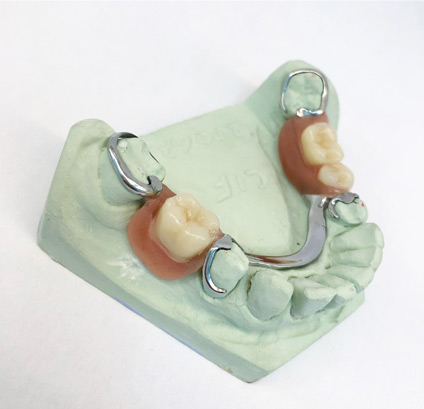 Partiële prothese of frameprothese | Van Engelen Tandprothetiek